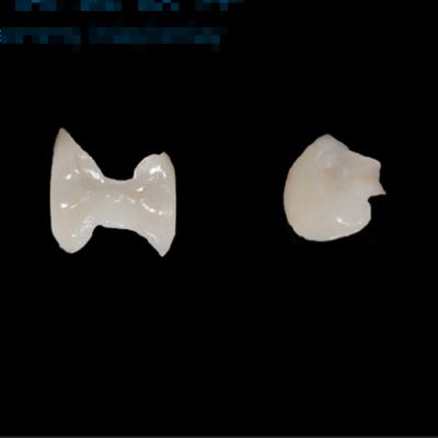China Lithium Disilicate Milling Crown Onlay Veneer High Accuracy Dental Inlay Onlay for sale
