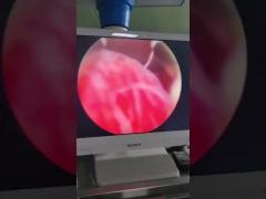 Instrumentos cirúrgicos personalizados de mínima invasividade sonda de plasma para ginecologia