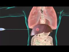 Eletrodo de cirurgia de radiofrequência de precisão para ablação de hepatotomia