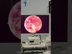 Cirugía UBE con Sonda de Cirugía de Plasma DaMai