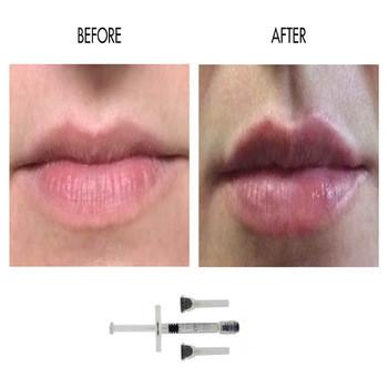 China Injectable dermal filler Anti-aging anti-wrinkle acido hialuronico for sale