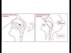 Oral Nasal Swab with Breakpoint for Virus Sample Collection