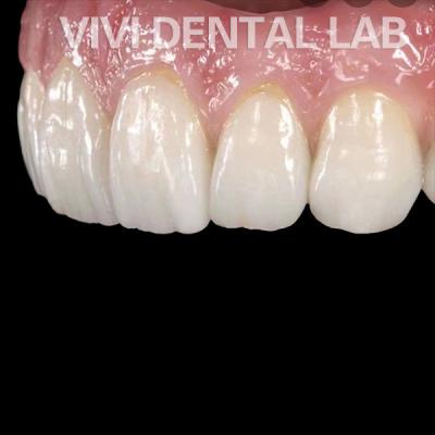 crowning a front tooth