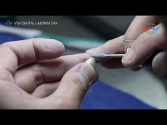 high esthetics full contour zirconia crown