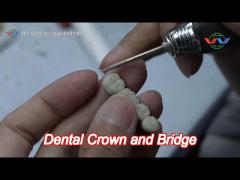 metal ceramic crown pfm crown and bridge from china dental lab