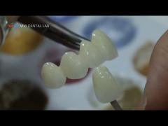 zirconia crowns pfz zirconia porcelain crown dental tooth crown