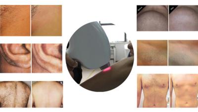 China 800 nm - 810 nm Medical Chin Diode Laser Hair Removal Machine For Clinic / Hospital for sale