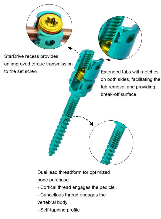 New Orthopedic Screws Monoaxial Reduction Screw for Orthopedic Surgical Implants Spinal Pedicle Screw 6.0 System