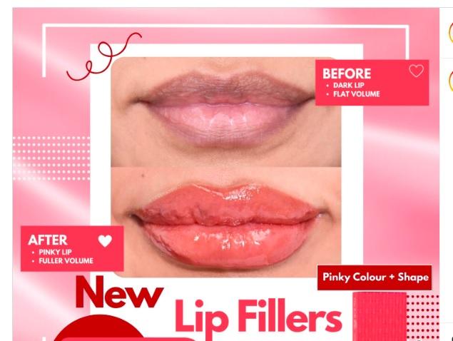 Injectable Hyaluronic Acid JUR KISS Filler For Lips Red Lip Augmentation Injection