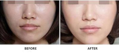 Cina Acido ialuronico del riempitore della grinza dell'occhio per la penna 20mg/Ml di Hyaluron Derma in vendita