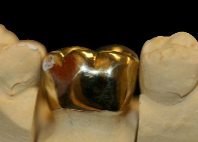 Cina Laboratorio dentario di protezione FMC del ponte fine ad alta densità della corona in vendita