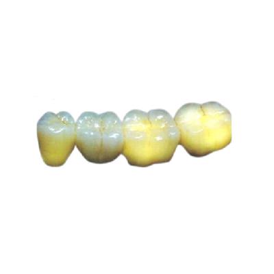 Cina Allergia estetica ad alta resistenza della corona dentaria resistente all'uso di PFM amichevole in vendita