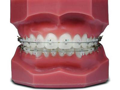 China Comfortable Fixed Orthodontic Appliances Beautiful Natural Ceramic Brackets for sale