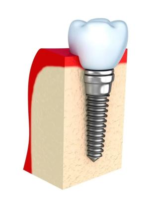 China Dentures Temporary Dental Implant Bar Single All Ceramic Teeth for sale