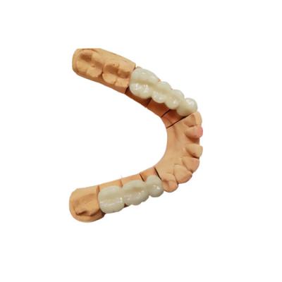 Cina Corona dentale PFM di alta qualità Aspetto realistico Colore stabile Non facile da indossare in vendita