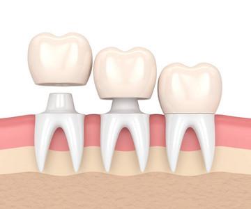 Cina Le bei corone e ponti dentari lisciano la superficie per la sicurezza di igiene orale in vendita