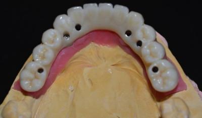 Cina Elevando le norme la nostra assicurazione di qualità della corona dell'impianto dentario in vendita