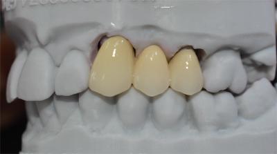 Cina Longevità e durevolezza un investimento di vita con le nostre corone dentarie ceramiche in vendita
