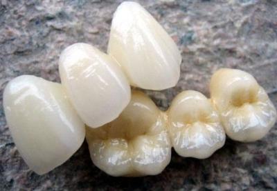 Cina Stabilità di colore su ordinazione del ponte dentario ceramico del Cr 3014652903 di PFM Co in vendita