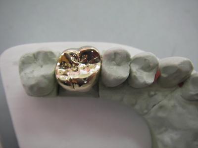 Cina Materiale biologico alta tecnologia del metallo PFM del ponte dentario pieno della corona in vendita