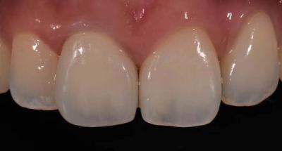 Cina Impiallacciatura della corona dentaria ceramica dei parti sovrapposti in rilievo degli intarsi forte per il dipartimento dentario in vendita