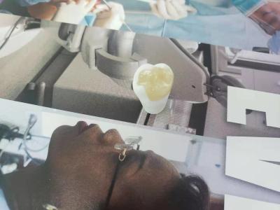 Cina Parte sovrapposto in rilievo dentario Tutto ceramico durevole dell'intarsio dell'impiallacciatura della corona di FDA simile in vendita