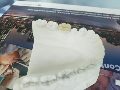 Cina Parte sovrapposto in rilievo dentario Tutto ceramico durevole dell'intarsio dell'impiallacciatura della corona di FDA simile in vendita