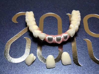 Cina Corona dentaria smontabile del singolo titanio flessibile per la clinica dentaria in vendita