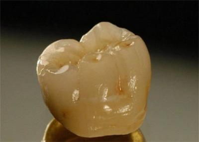 Cina Corona dentaria dell'inter porcellana di miscibilità in vendita