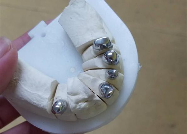 Flexible Durable Precision Attachment Denture Corrosion Resistant