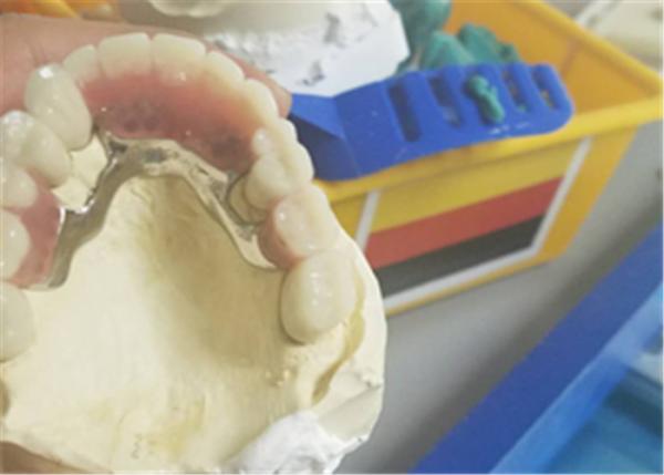 Flexible Durable Precision Attachment Denture Corrosion Resistant