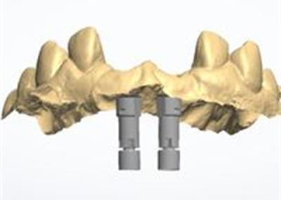 China 3D model Zirconia crown for sale