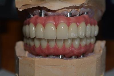 Cina Corone per impianti dentali di precisione per il comfort e la sicurezza in vendita