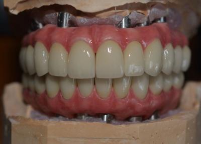 Cina Corone per impianti dentali di precisione per il comfort e la sicurezza in vendita