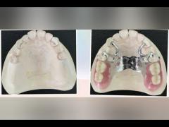Belle couleur transparente d'entretien facile invisible orthodontique démontable de serviteur