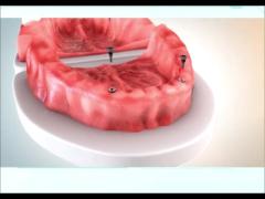 Natrural Shade 3D Printing Fixed Removable Denture For Dentist Study