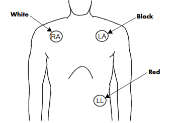3-wire ECG lead placement diagram
