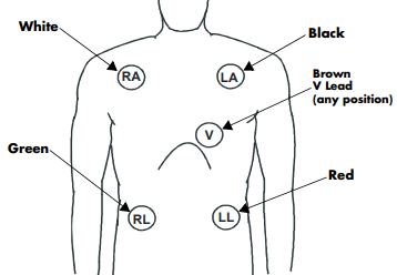 5-wire ECG lead placement diagram