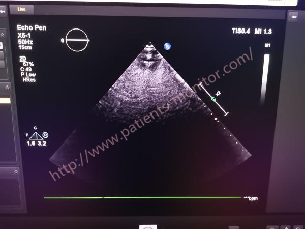 Série de PHiliph EPiQ da ponta de prova do transdutor da disposição do ultrassom X5-1 XMATRIX