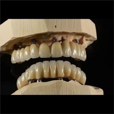 China All On 6 PFM Titanium Bridge Dental Crown Full Arch Implant for sale