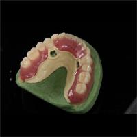 China OEM Peek Cast Metal Framework Partial Denture User Friendly for sale