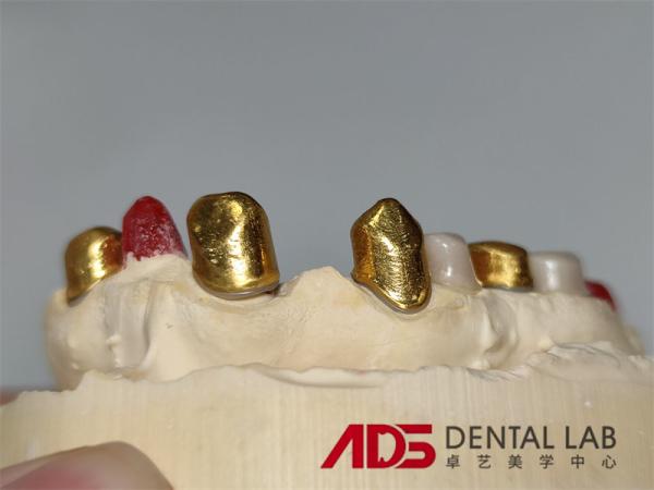 Quality Dental Telescopic Crowns Prosthesis In Dentistry Customizable for sale