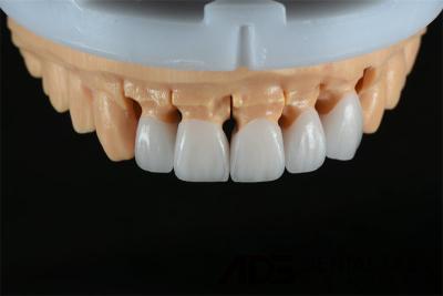 Cina Cina Dental Lab Laminato Dental E-Max Veneer Autoadesivo in vendita