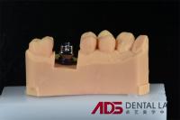 China Dental Missing Teeth Cement Retained Implant Crown Replacement Custom for sale