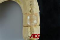 China Seamless Porcelain Emax Veneers Teeth Replacement Authentic Looking for sale