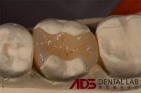 China Seamless Porcelain Emax Veneers Teeth Replacement Authentic Looking for sale