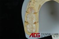 China Seamless Porcelain Emax Veneers Teeth Replacement Authentic Looking for sale