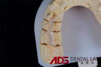 China Seamless Porcelain Emax Veneers Teeth Replacement Authentic Looking for sale