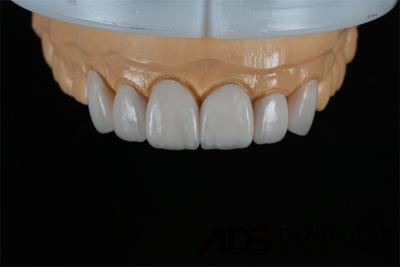 Cina Porcellana Naturale E-Max Corona Full Veneer In Restauri Demistry in vendita