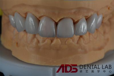 Cina Porcellana Naturale E-Max Corona Full Veneer In Restauri Demistry in vendita